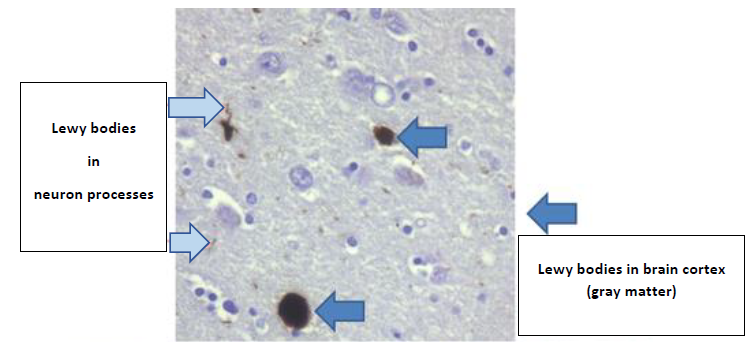 Fig. 6.14 Microscopic views of Lewy bodies (Source ofimage below. Used ...